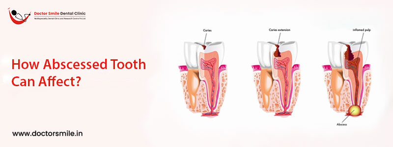 Your Best Dentist To Treat Abscessed Tooth